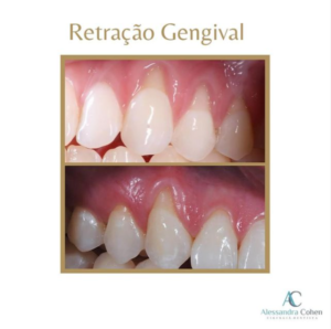 Retração Gengival - Dra. Alessandra Cohen